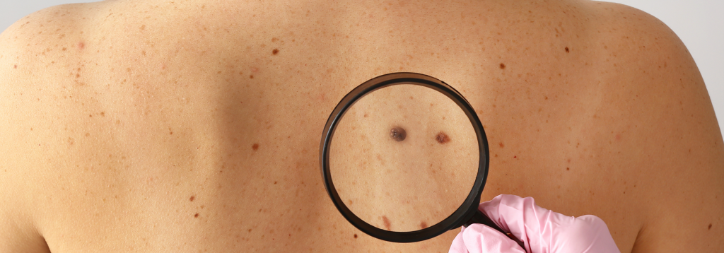 What does skin cancer look like - Evergreen Life