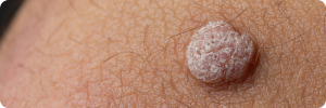 How to get rid of skin tags - Evergreen Life