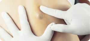 When to worry about a lump under skin Evergreen Life